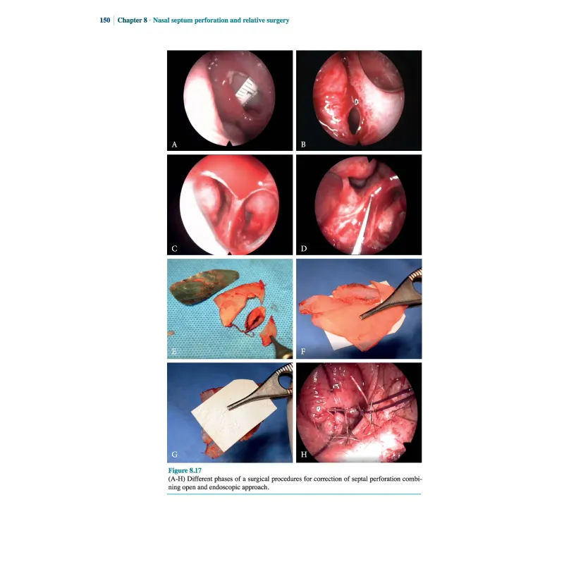 The Nasal Septum - Riccardo Nocini, Gabriele Molteni, Stelio Antonio ...